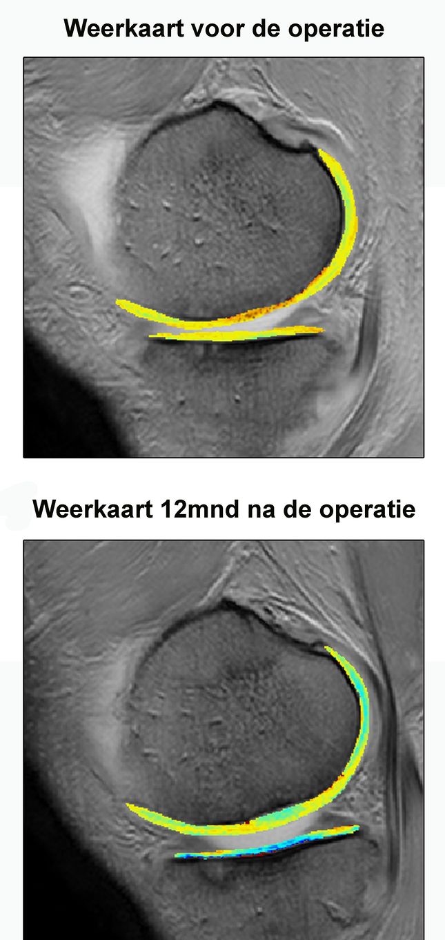 Persoonlijke zorg voor het kraakbeen - NEMO Kennislink