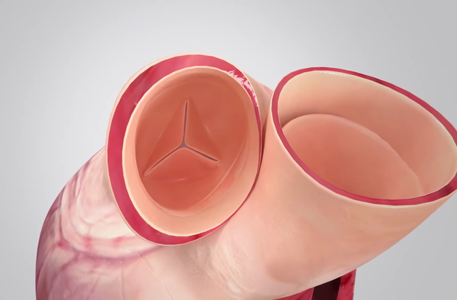 Alternatief voor kunsthartklep: implantaat dat na plaatsing ...